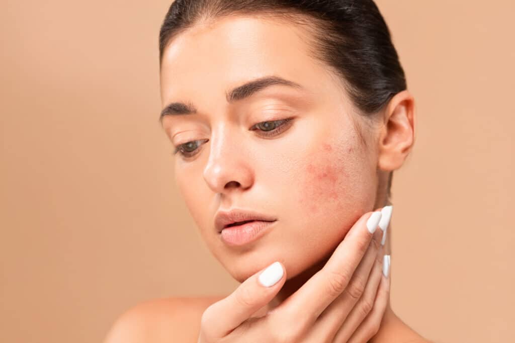 Traitement des cicatrices d’acné | Dr Christine Luneau | Aix-en-Provence